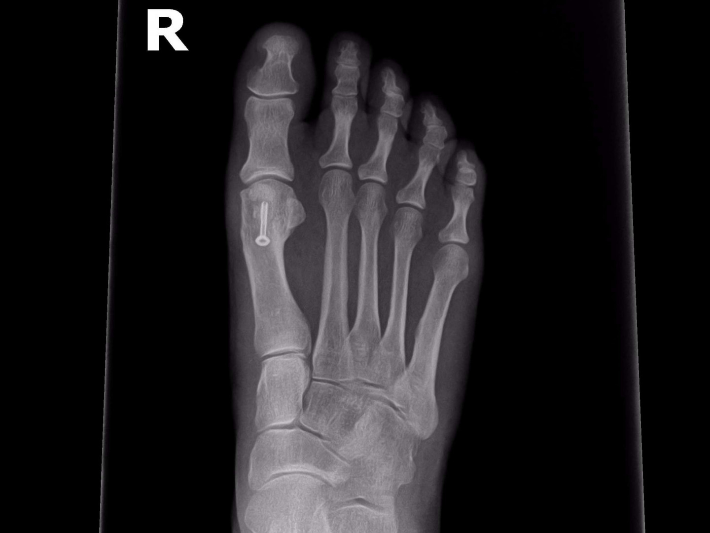 Foot & Ankle Services: Bozeman MT | Bozeman Foot and Ankle Clinic Foot & Ankle Services: Bozeman MT | Bozeman Foot and Ankle Clinic